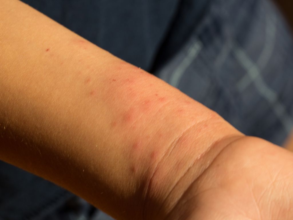 Bed Bug Bites: Symtoms And Treatment | Dyno-Pest